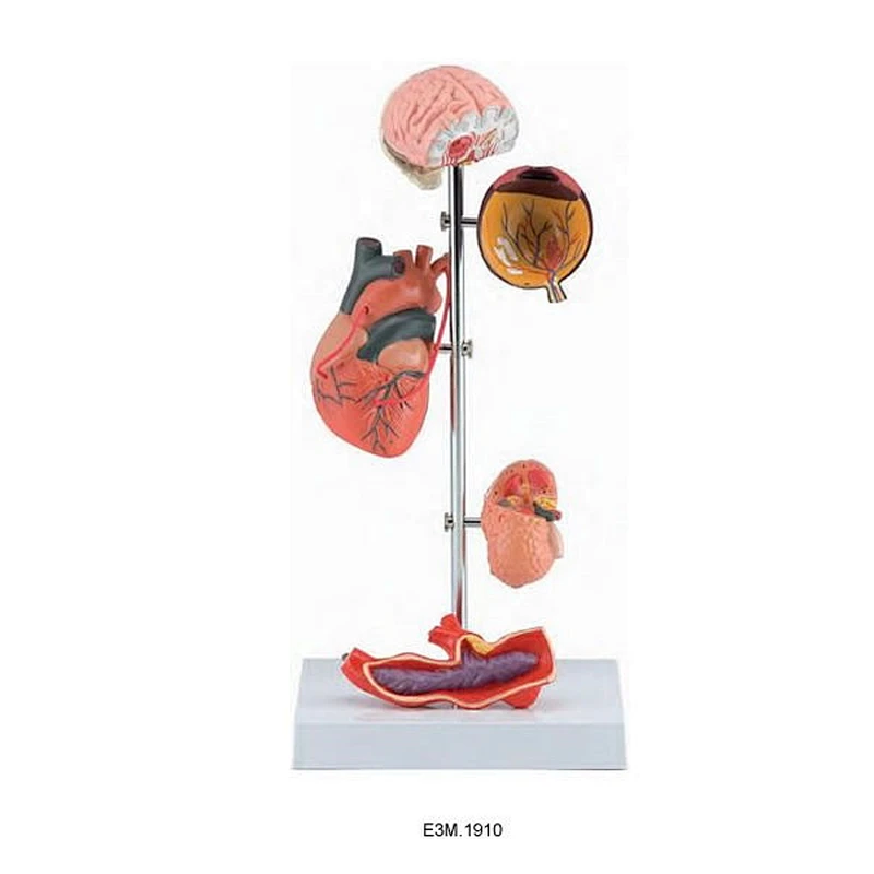 Hypertension Model II,5 parts