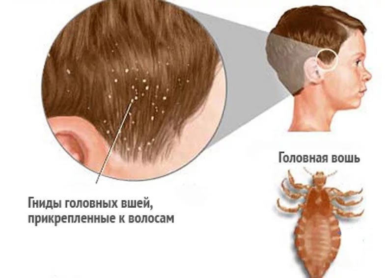 Will a Sauna Kill Lice? - Huizhou Alpha Sauna Swimming Pool Equipment ...